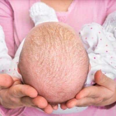 Le psoriasis du nourrisson : informations, définition, symptômes et ...