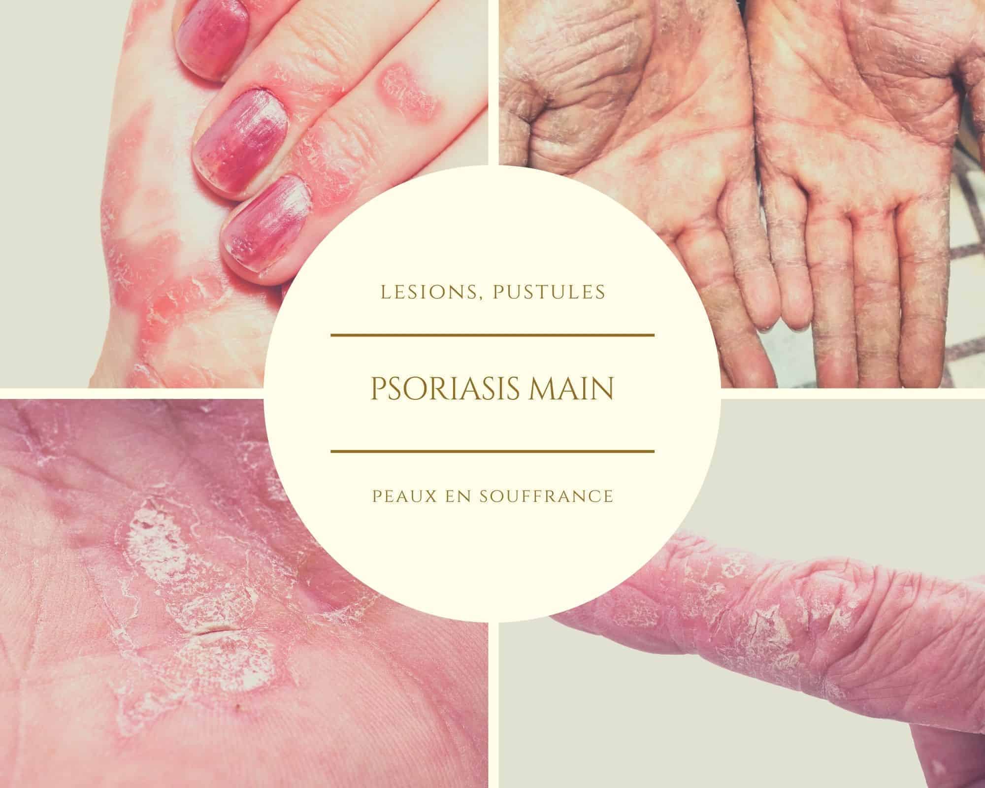 Psoriasis main, comment soulager rougeurs, crevasses et démangeaisons ...