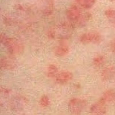 Information psoriasis : causes, symptômes, traitements naturels ou ...
