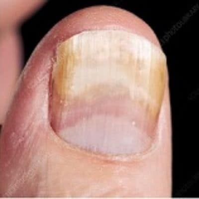 Information psoriasis : causes, symptômes, traitements naturels ou ...