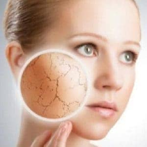 Eczéma peau sèche : comment remédier à la sécheresse cutanée