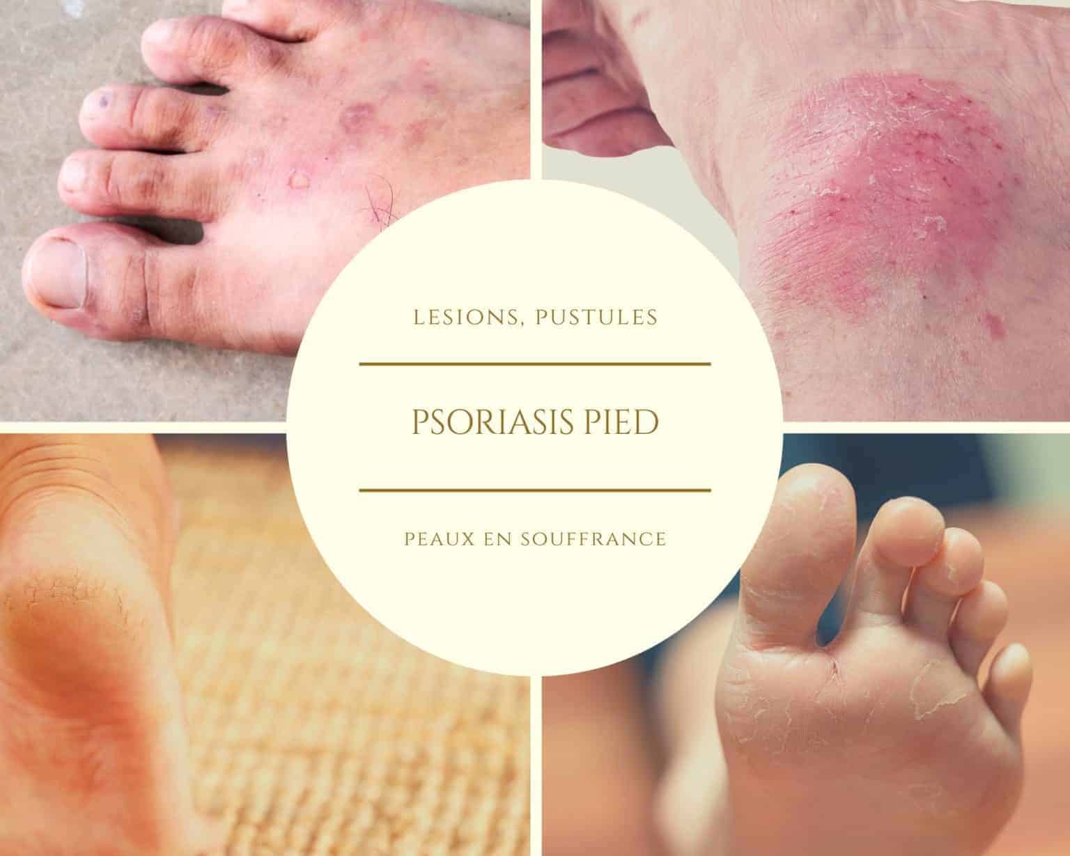 Psoriasis pied, comment s'en débarrasser, sans corticoïdes