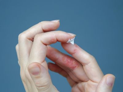 Information eczéma, traiter les symptômes au naturel