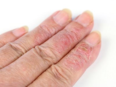 Information eczéma, traiter les symptômes au naturel