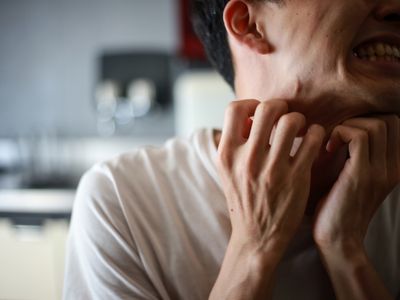 Eczema information, treating symptoms naturally