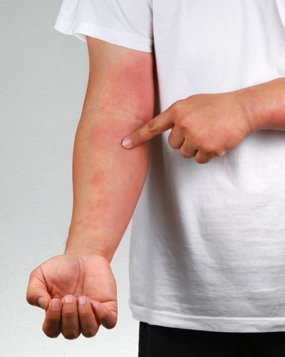 Soin naturel eczéma et dermatite atopique pour se débarrasser des marques