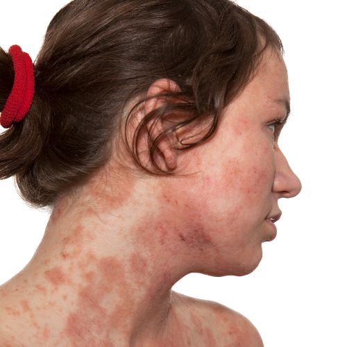 Psoriasis des paupières : comment le soulager