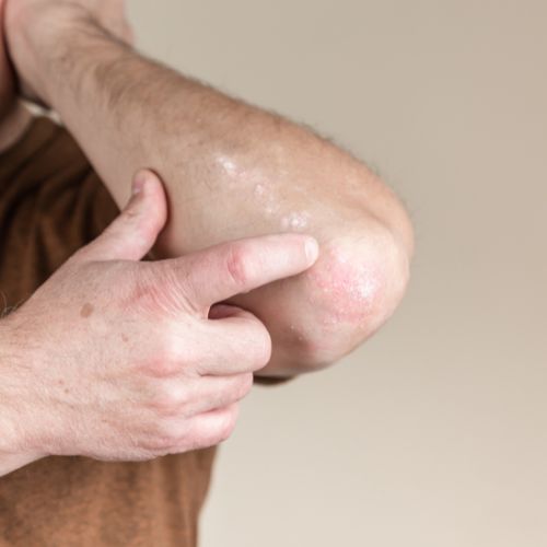 Comment reconnaitre et soigner le psoriasis du coude
