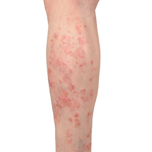 Causes du psoriasis et facteurs responsables des poussées
