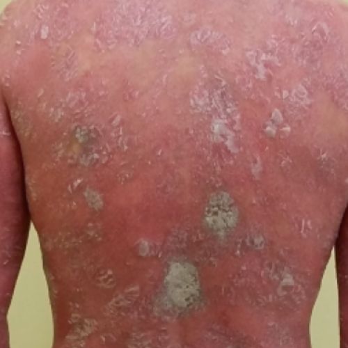 Contagious psoriasis? Myths and realities about its contagiousness...