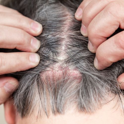 Psoriasis et perte de cheveux, causes, symptômes traitements