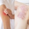 Psoriasis : comprendre la maladie en photos et explications