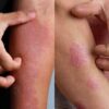 Psoriasis : comprendre la maladie en photos et explications