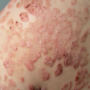 Psoriasis : comprendre la maladie en photos et explications