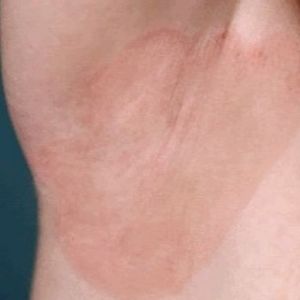 Psoriasis : comprendre la maladie en photos et explications