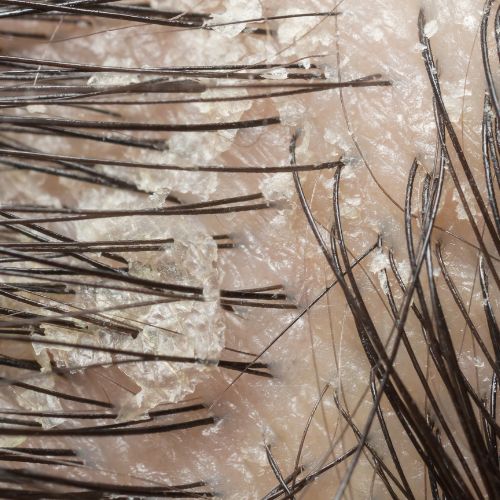 Traitement efficace des croûtes au cuir chevelu : shampoings et autre ...