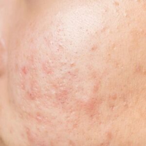 Acné rétentionnelle : causes, solutions, soins et conseils pour une ...