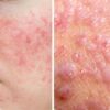 Acné rétentionnelle : causes, solutions, soins et conseils pour une ...