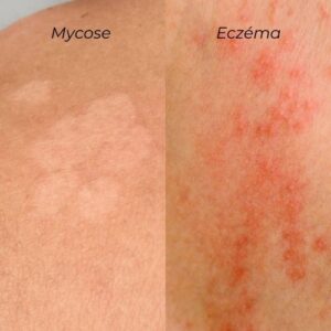 Eczéma en photos : reconnaître les symptômes et traitements